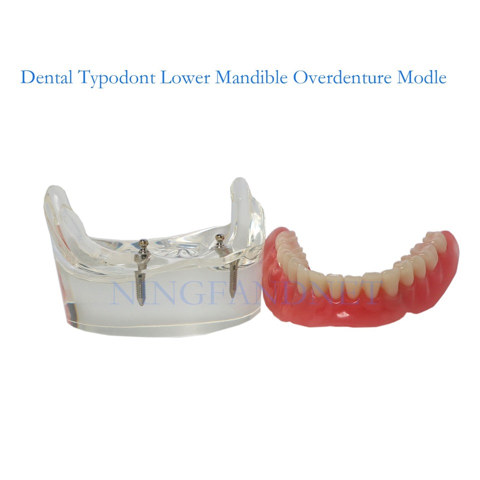 Dental Implant Modle,Lower Upper Jaw,RPD Dentures,Overdenture ...