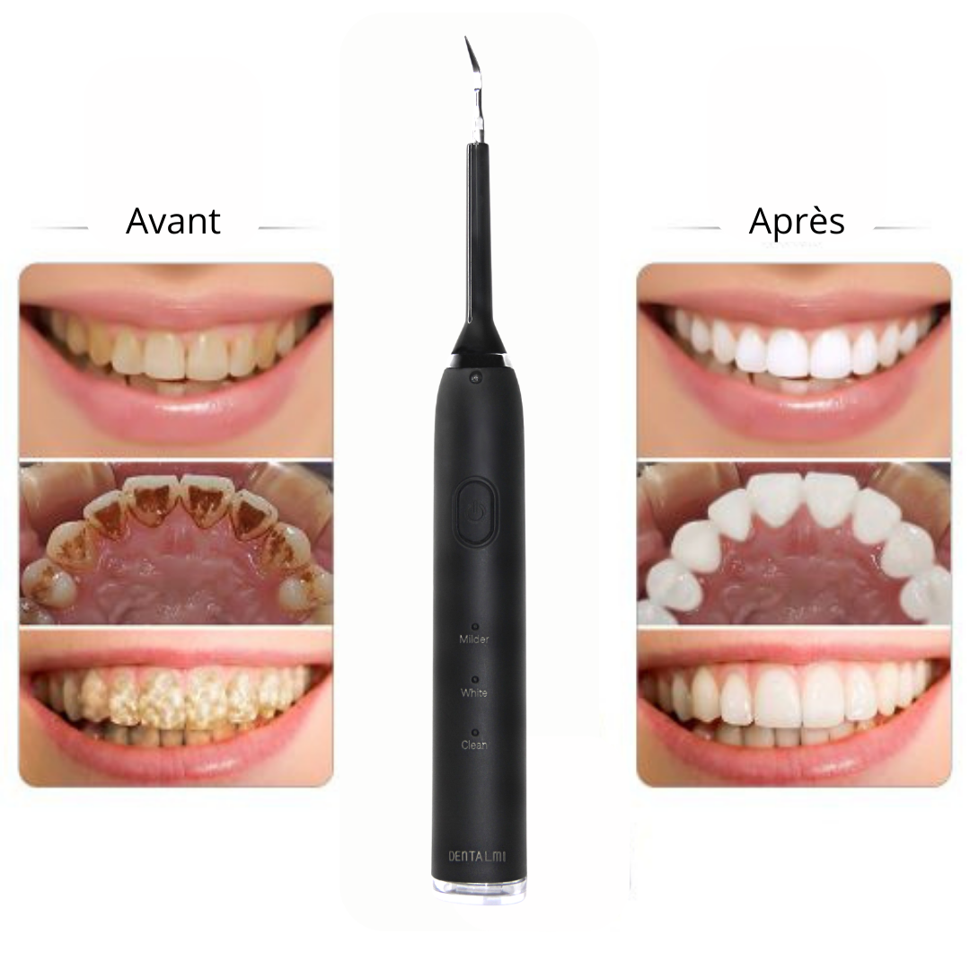 Appareil Detartrage Dentaire Maison | Ventana Blog