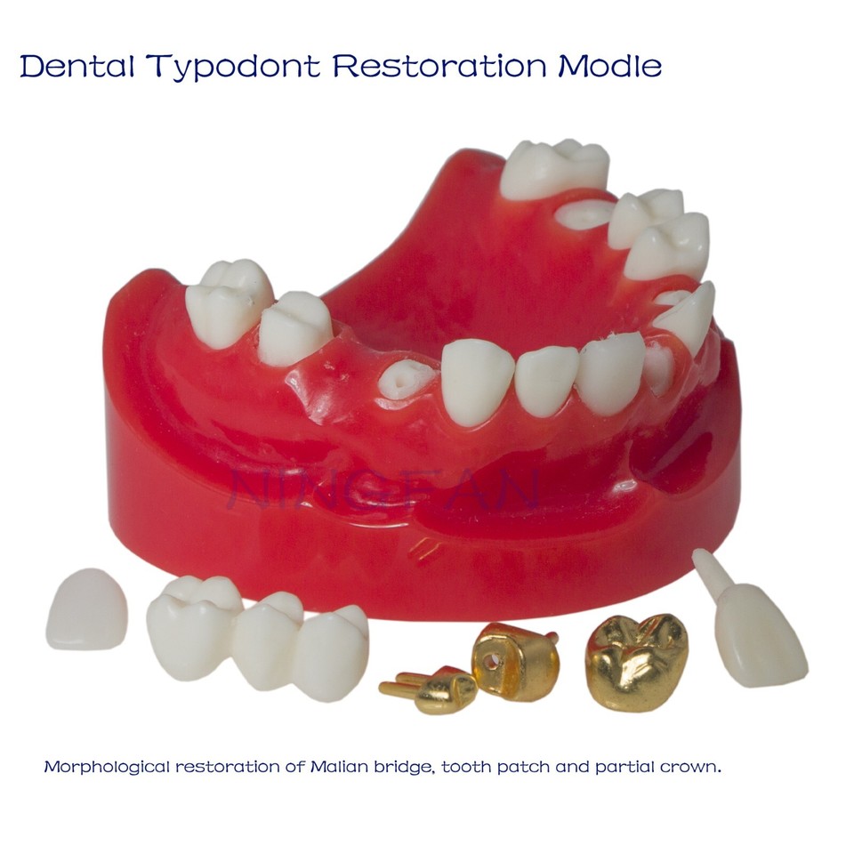 Dental Typodont Restoration Model, Tooth Patch, Crown, Bridge Repair ...