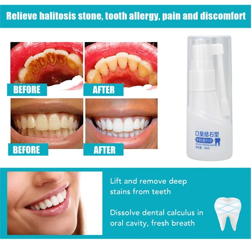 30ML Dental Cleaning Spray Relieve Halitosis Calculus Tooth Allergy ...