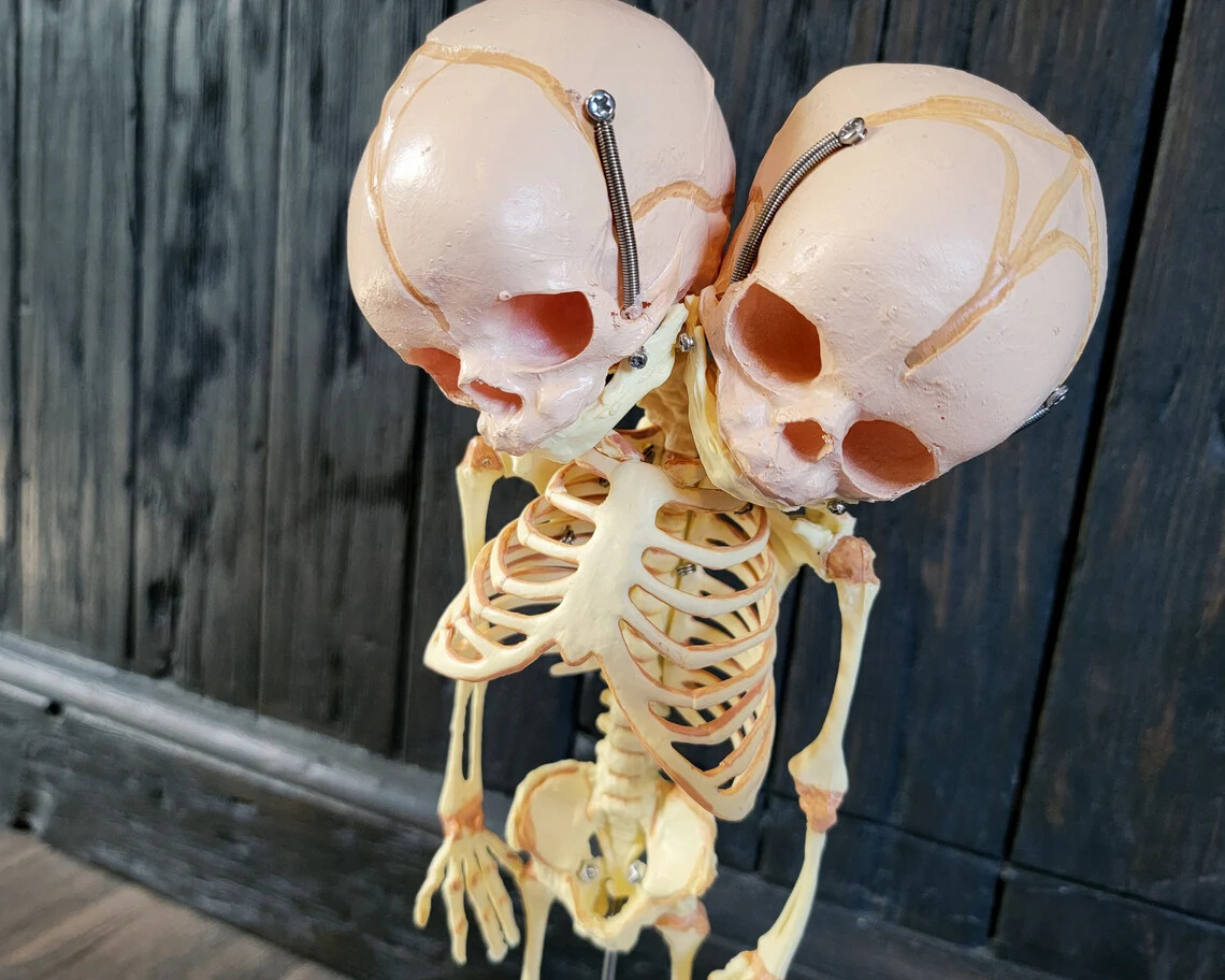 Conjoined Twin Skeleton