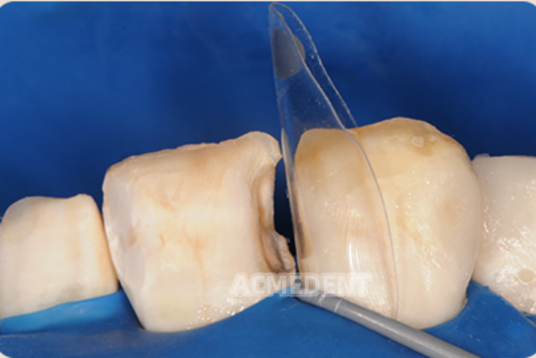 Clear Matrix Dental Anterior Matrices Posterior Class II Fit BioClear ...
