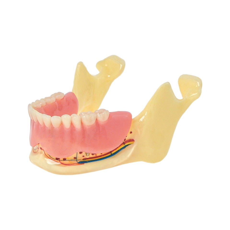 Implant Model Dental Practice Restoration Telescope Crown Covering ...