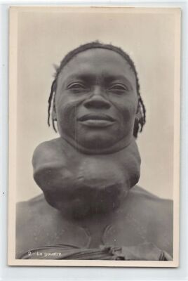 Congo Kinshasa - Le goître (spelled gouatre) - REAL PHOTO - Africa that ...