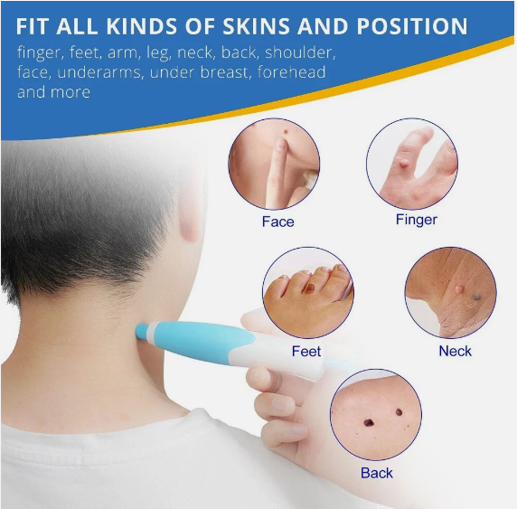 2-in-1 Micro Auto Skin Tag Remover Pen Tool Kit Painless Wart Skin Tag ...