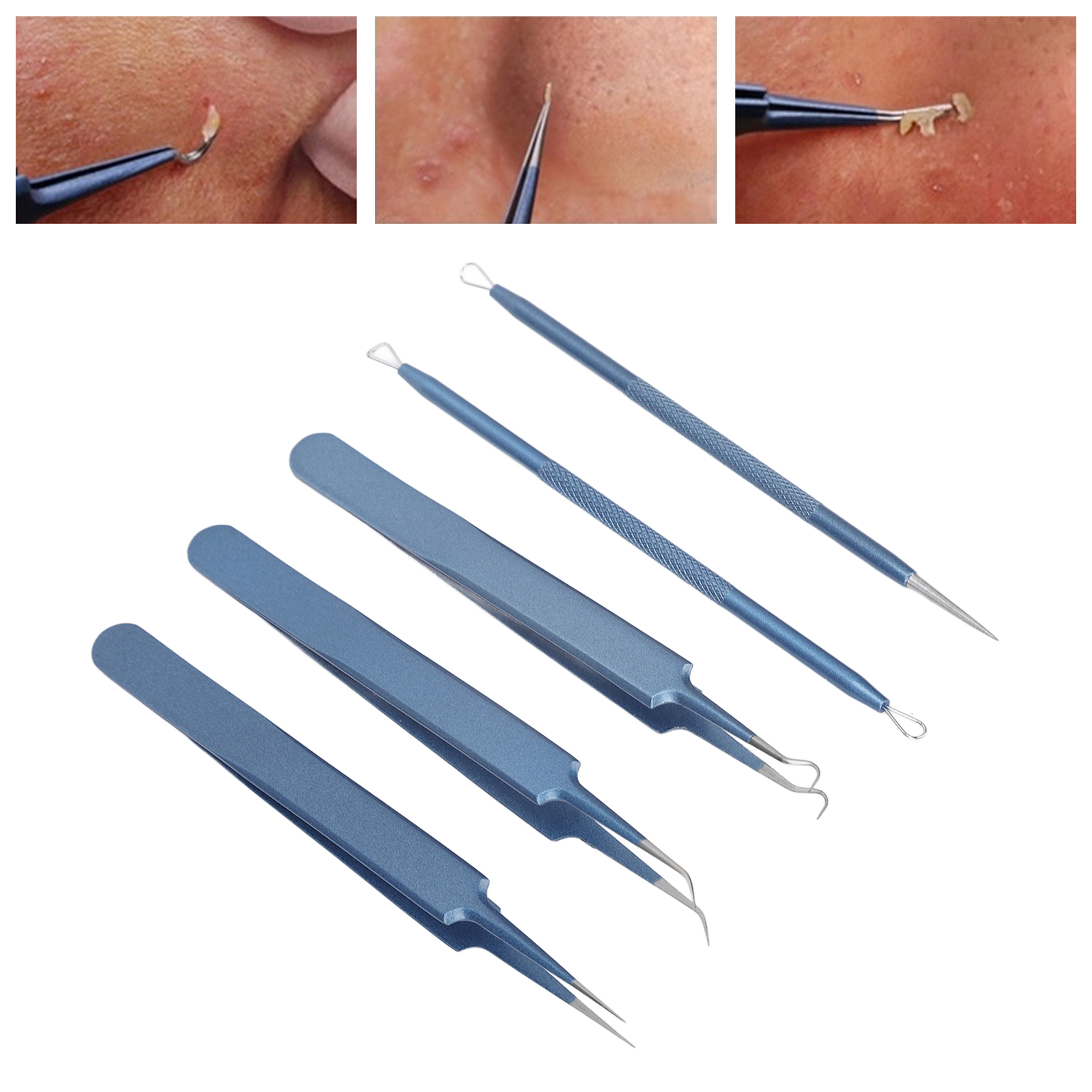 5pcs Blackhead Remover Stainless Blue Acne Needle Set For Pimple Popper ...