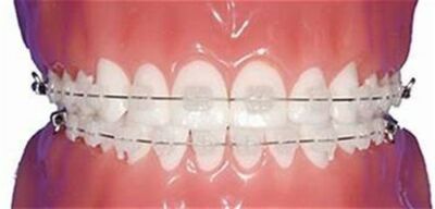 Ceramic Twin Brackets, Roth, .018, 20/Kit, Modern Arch | eBay