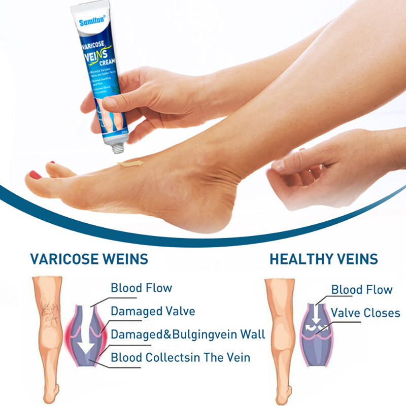 Varicose Veins Treatment Cream Vasculitis Phlebitis Spider Cream ...