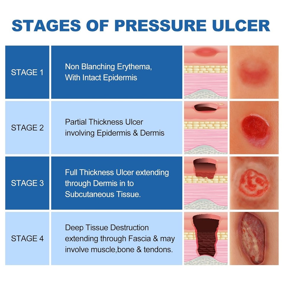 Decubitus Ulcer Wound Care Model Bedsores Model Pressure Injury Model ...