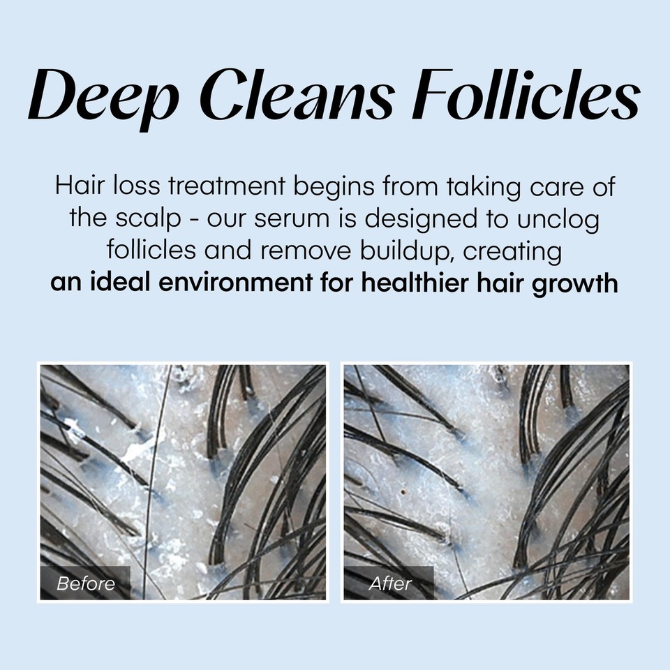 Scalpy Hair Growth Treatment Topical Serum for Hair Loss, Thinning ...