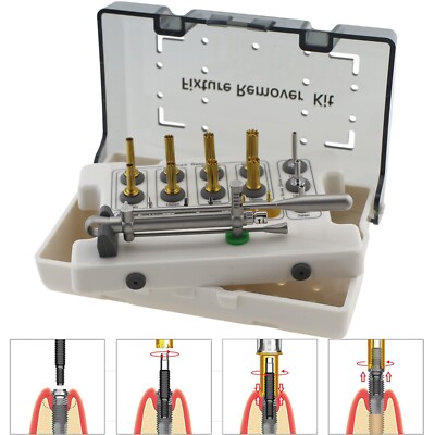 Implant Fixture Removal Kit Remover Failed Dental Implants Extraction ...