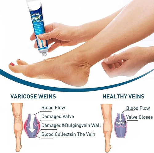 Mucopolysaccharide Polysulfate Cream, Varicose Veins Cream, Legs Care ...