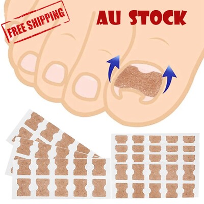 50/100x Ingrown Nail Correction Patch Glue Free Toenail Sticker Toe ...