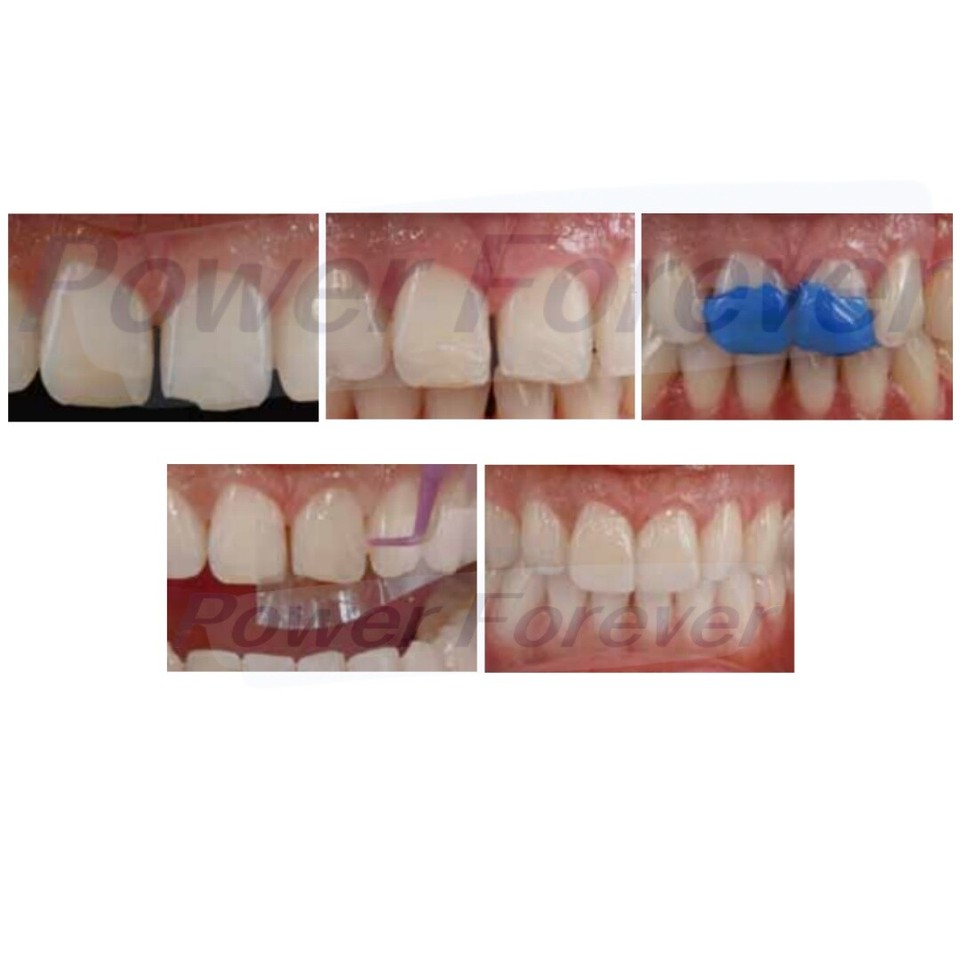 BXL Dental KULZER CHARISMA Composite Syringe Light Cure Resin Extremely Light | eBay