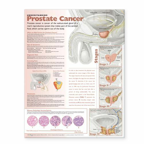Understanding Prostate Cancer Anatomical Chart (Paper) 9780781782241| eBay