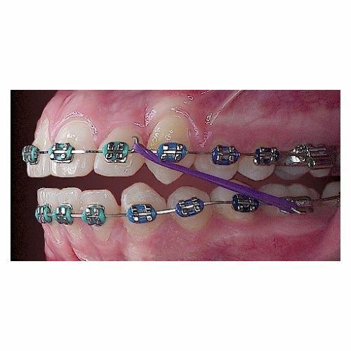 10x Dental Orthodontic Intraoral Latex Elastics Rubber Teeth Fox Ø1/4 ...