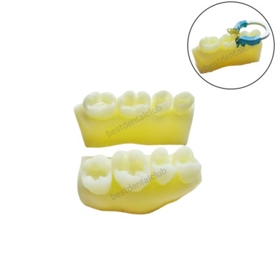 Dental Caries Model Composite Resin Restorative Simulate Class II Decay ...