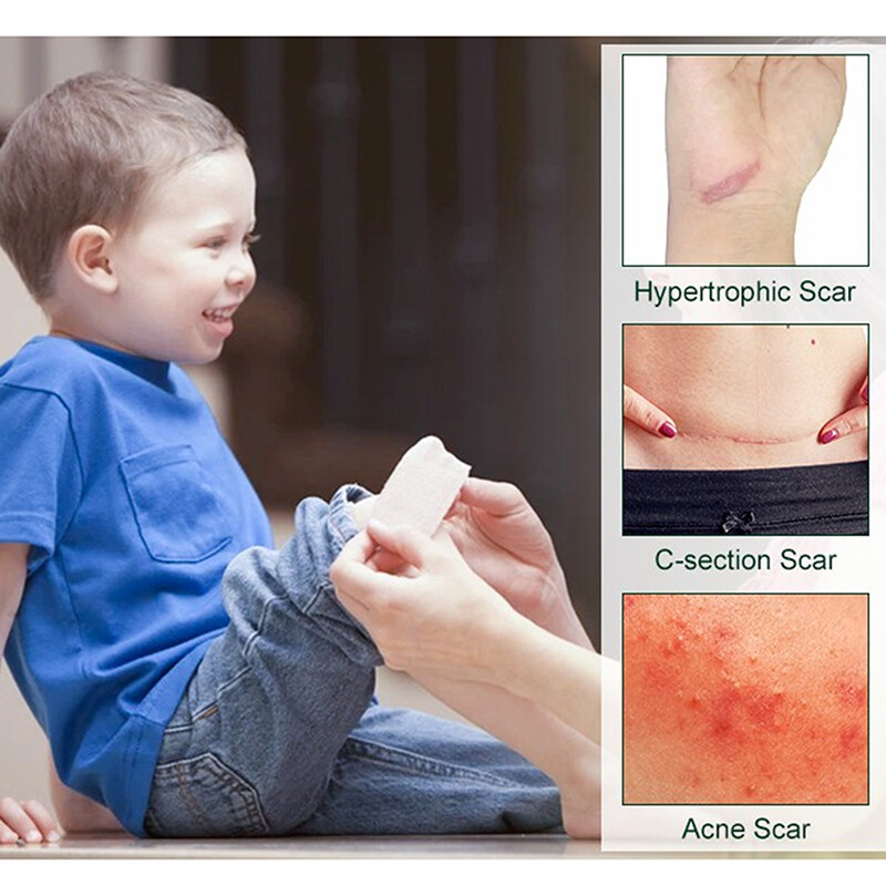 Surgery Scar Removal Sticker Sheet Patchs Silicone Gel Scars Treatment ...
