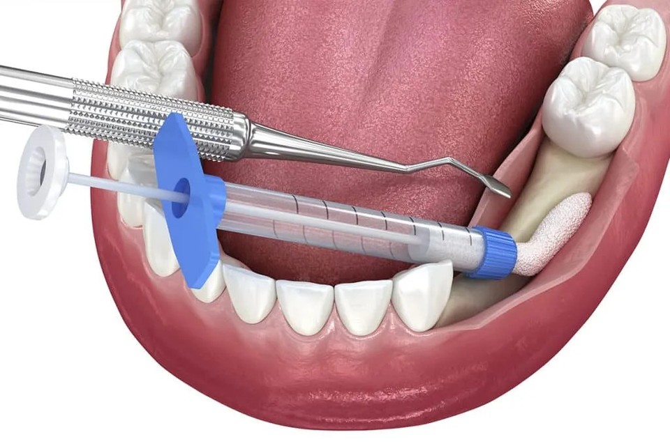 Advanced Biotech Osseograft Bone Matrix (DMBM-XENOGRAFT) for Bone void ...