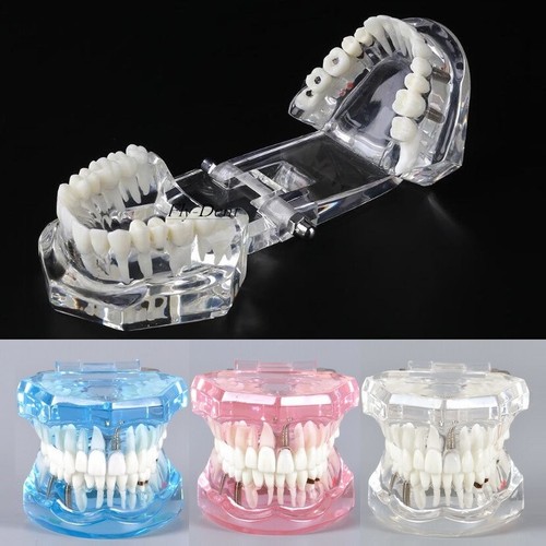 Dental Teeth Model Implant Disease Oral Bridge Restoration Pathology ...