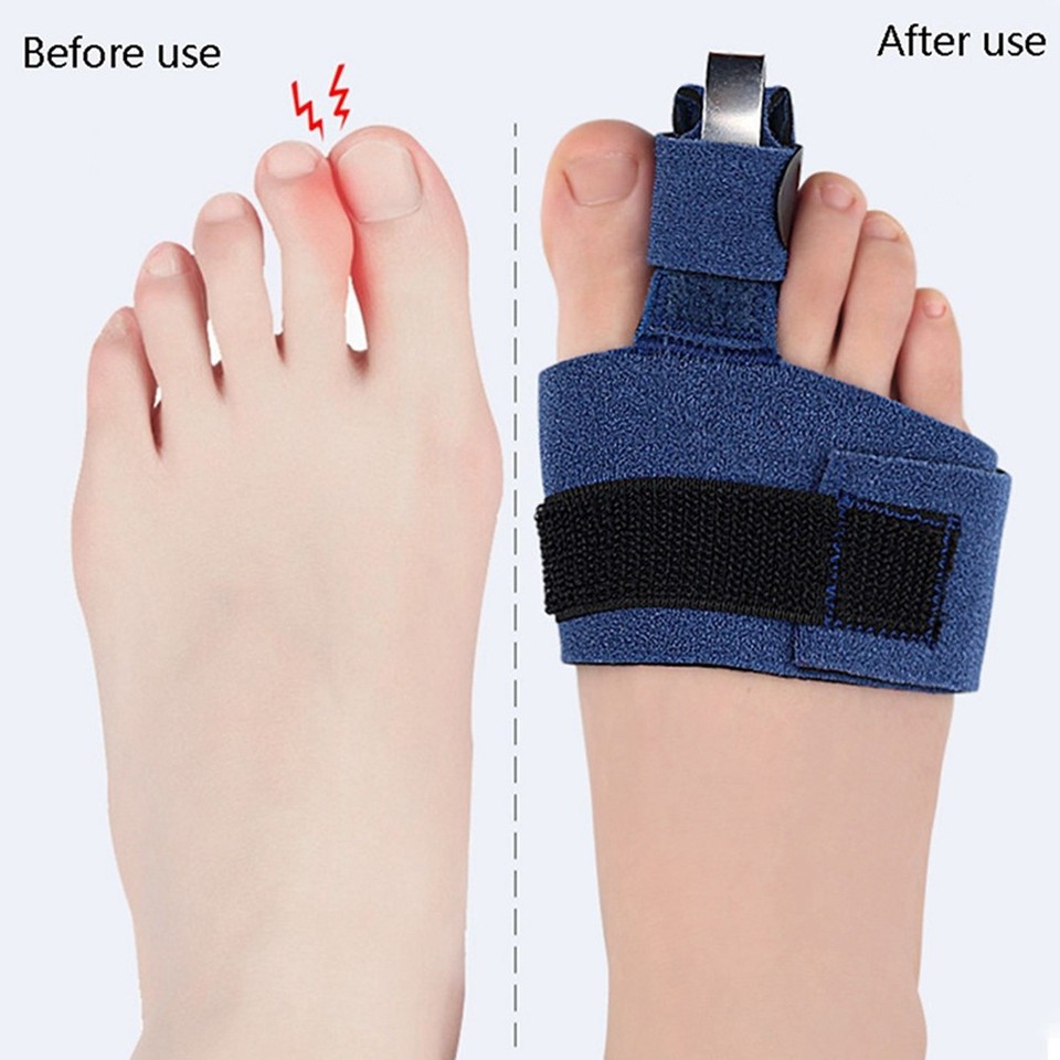 Toe Corrector Bunion Straightener Orthotic Toe Fracture Fixator ...