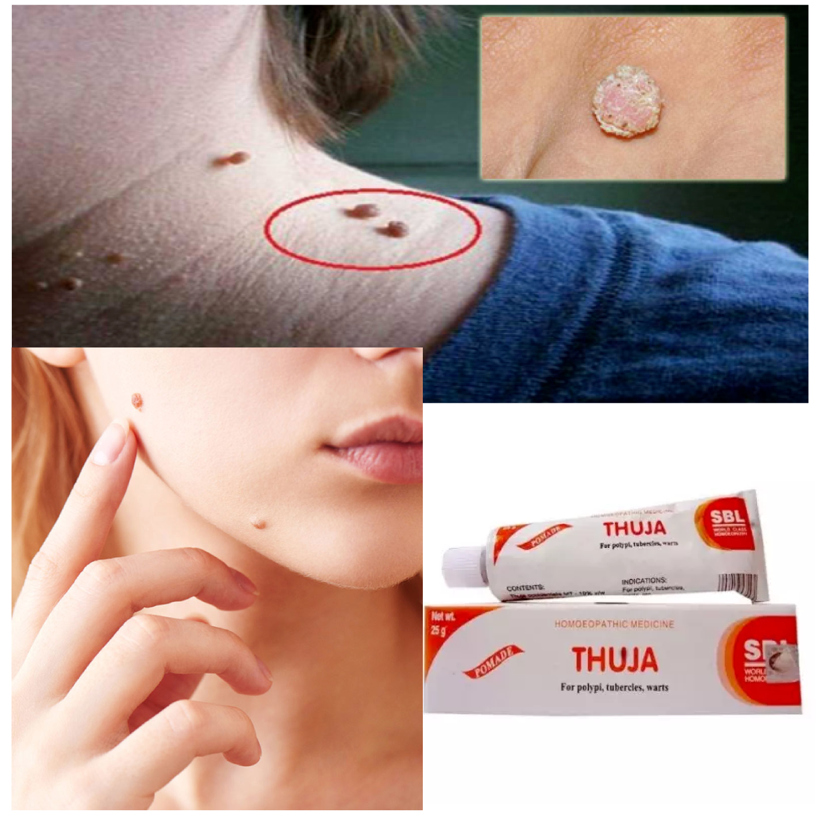 SBL Thuja Homeopathic Wart Remover Herbal Cream Mole Corn Skin Tag ...