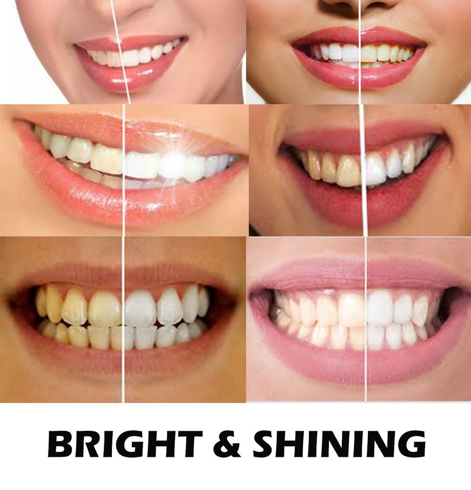 45% Teeth Tooth Whitening Whitener Bleach Kit White Gel 4 Syringes 40ml ...