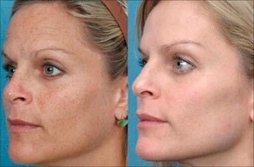 MATRIGEN FEEL+ MESO BB BRIGHTENING CONTROL SYSTEM. Newest Version 2023 ...