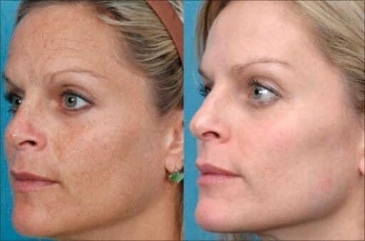 MATRIGEN FEEL+ MESO BB BRIGHTENING CONTROL SYSTEM. Newest Version 2023 ...