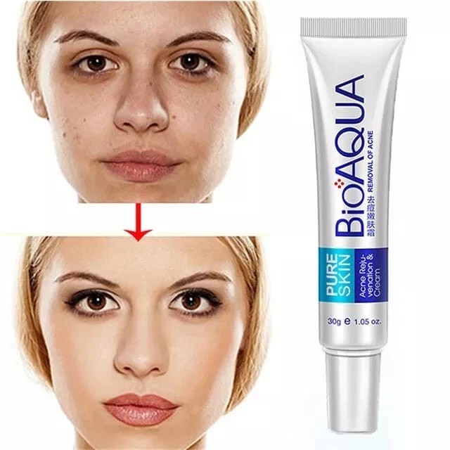 Bioaqua Acne cream pure skin care acne removal essential skin ...