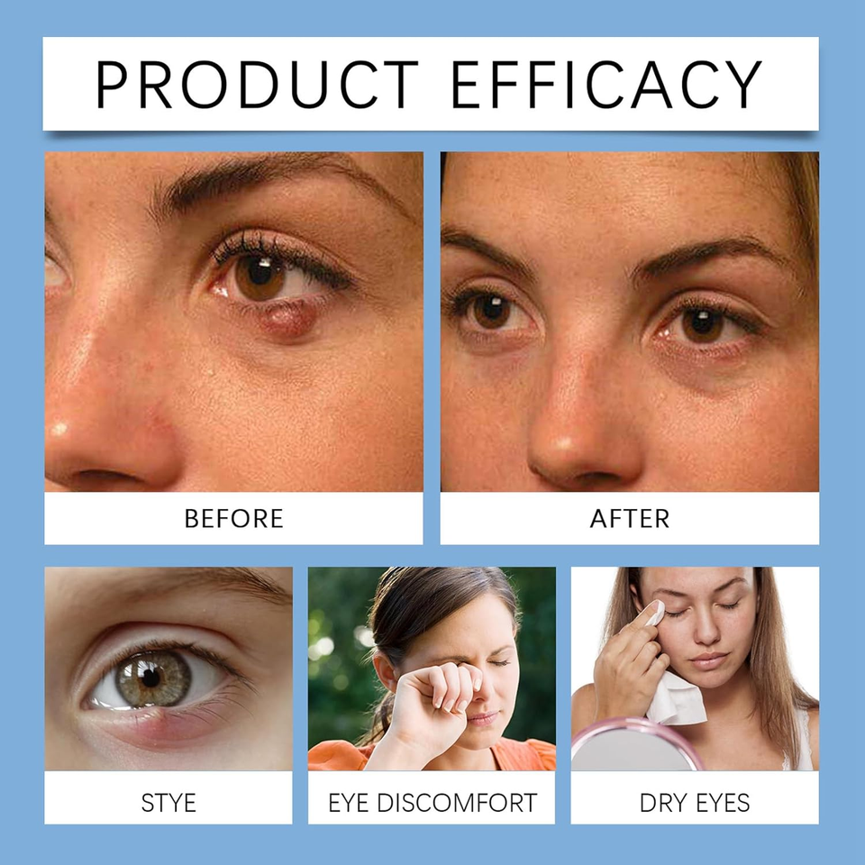 Chalazion & Blepharitis Treatment Eye Cream,Stye Eye Treatment, Reduce ...