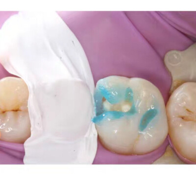 Dental Supplies - Matrix Bands