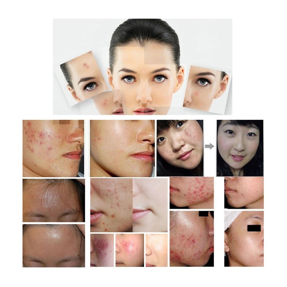 Spider Vein Eraser Blue Light Therapy Wrinkle Acne Laser Removal Pen ...