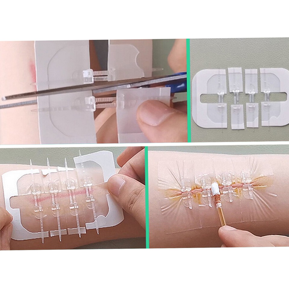 1/2/3/4/5 x Wound Closure Strips Emergency Protection Zip Stitch ...