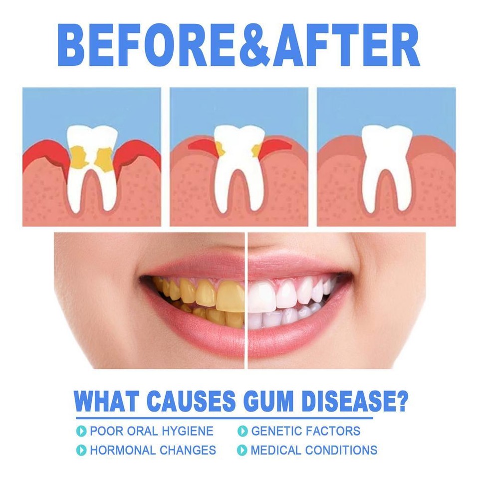 Damaged Gum Repair Care Gel Relieve Sore Gums Deep Cleaning Teeth ...