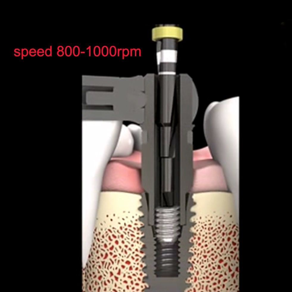 US Dental Implant Screw Remover Rescue Tool Broken Screw Removal Kit ...