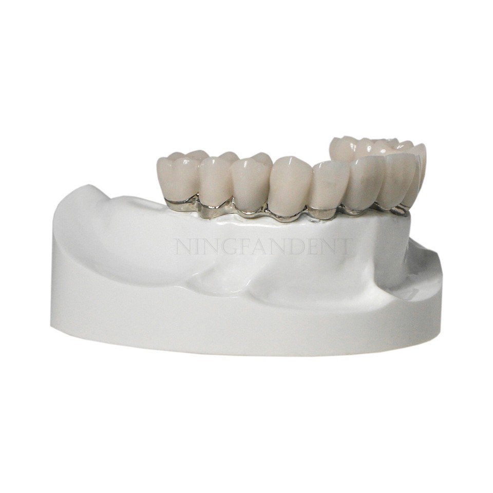 Dental All-On-4 Overdenture Implant Model Upper Pure Titanium Bridge, 4 ...