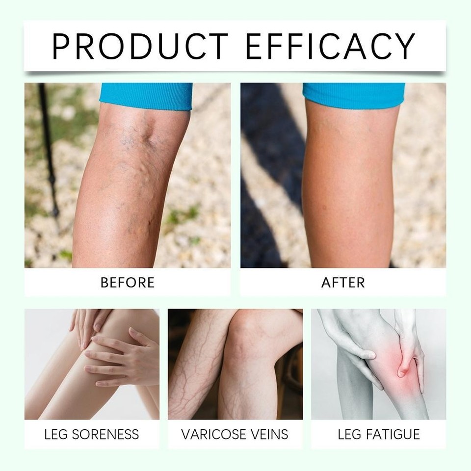 Edema Free Flow Drain Massage Cream, Improves Varicose Veins Cream Leg ...