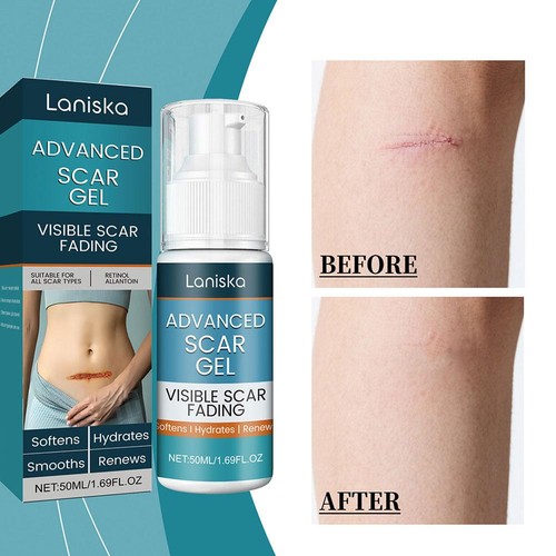 Scar Fading Acne Cream Silicone Removal Fade Old New Treatments Body ...