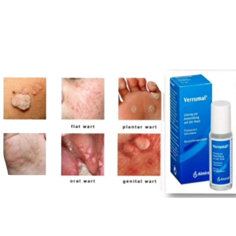 3X -Almirall Verrumal Solution for Effective Removal of Warts and ...