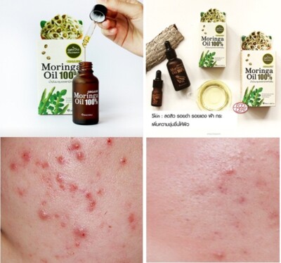 Phutawan Organic Moringa Oil 100% Reduce Acne. Smooth Surface 5 ml | eBay