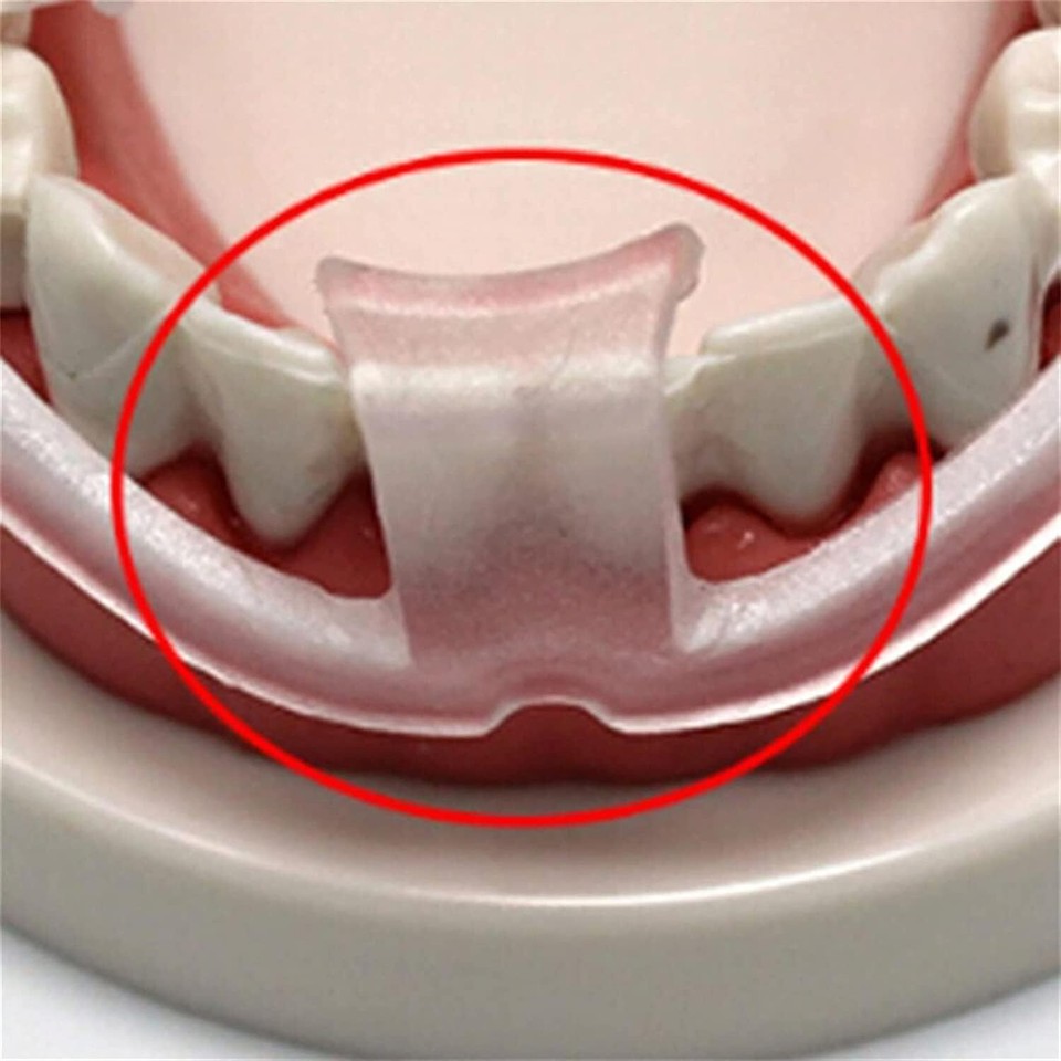 Tooth Grinding Dental Mouth Guard Bruxism Splint Sleeping Trans parency ...