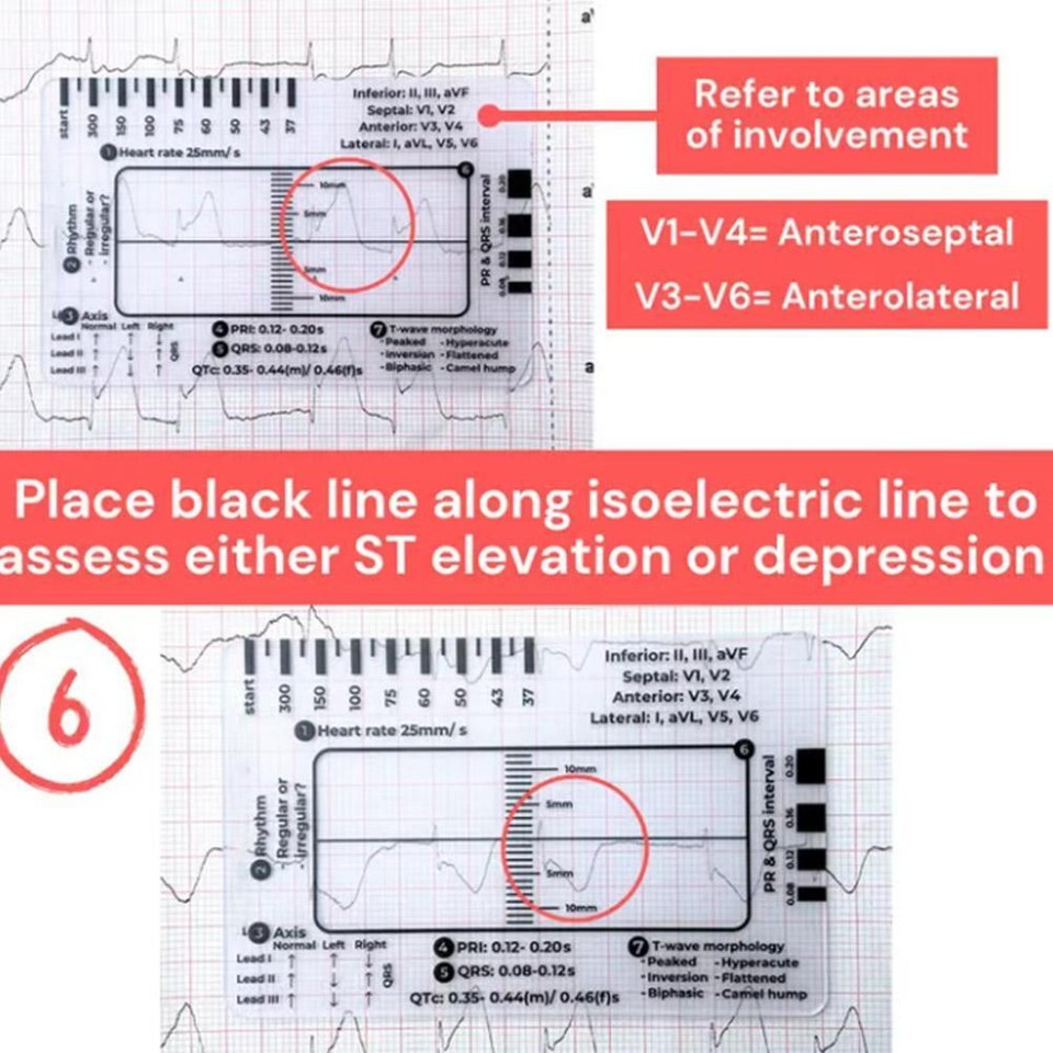 ECG Analysis & Interpretation (EKG) Medical EKG Cardiometer Ruler ...