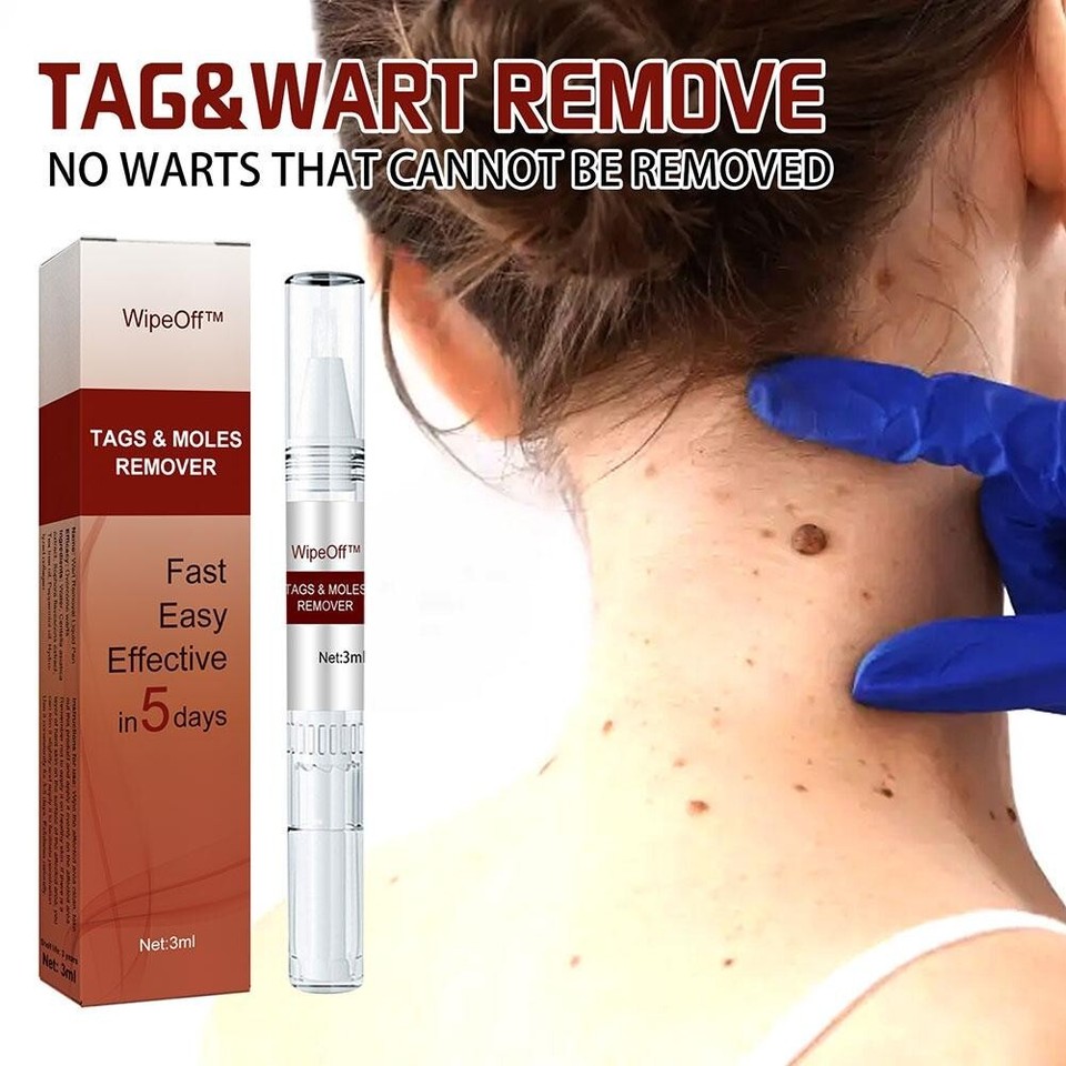 Wipe Off Skin Tags Moles Wart Remover Liquid Pen Fast Effect Genuine ...