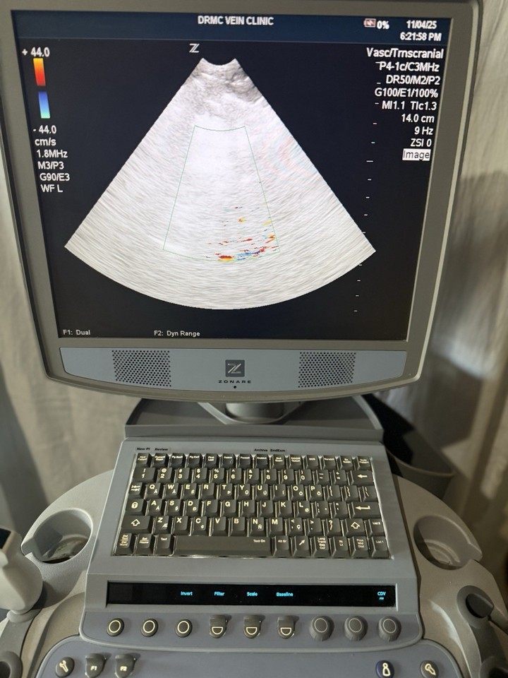 Zonare Z.one Scan Module Ultrasound Machine With Smart Cart And 2 ...