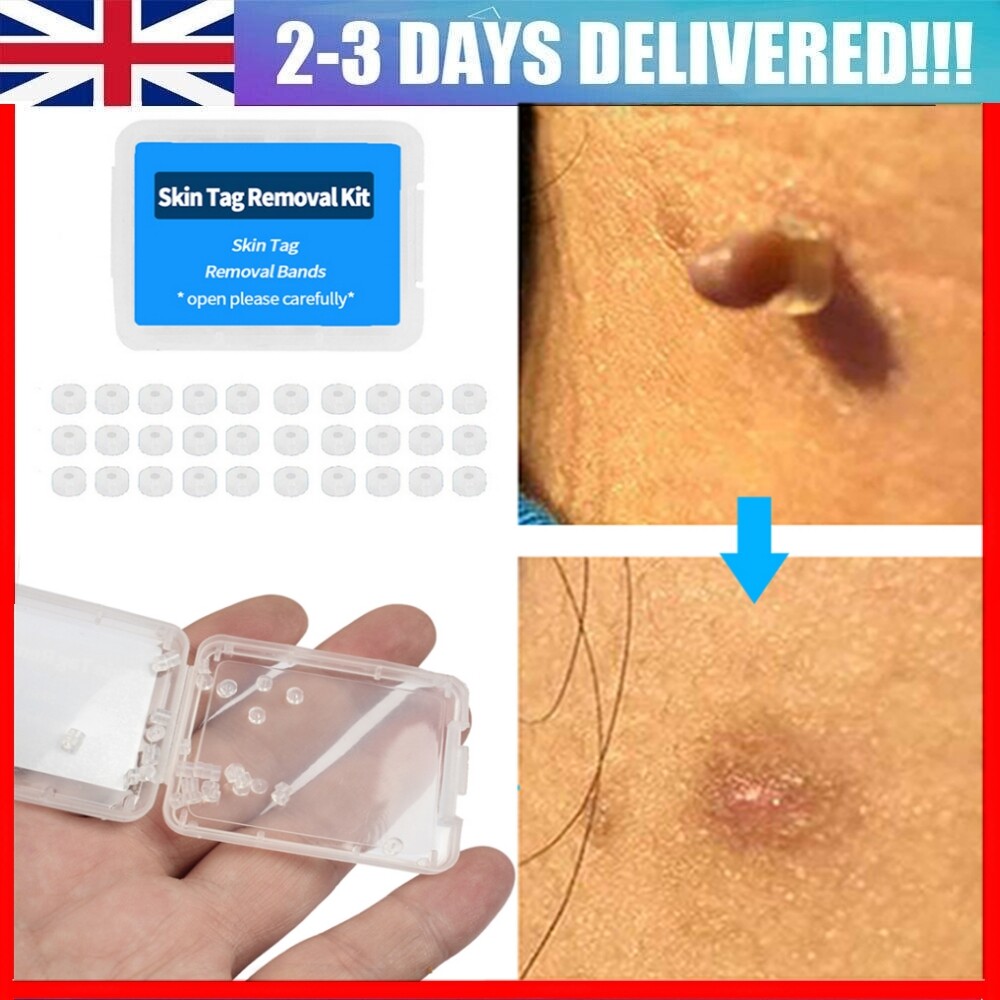 30-120× Skin Tag Removal Rubber Bands Micro Band Non Toxic Face Care ...