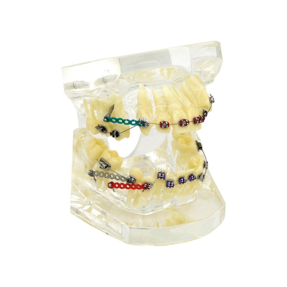 Dental Orthodontic Teeth Model With Metal Ceramic Brackets Tube Hawley ...