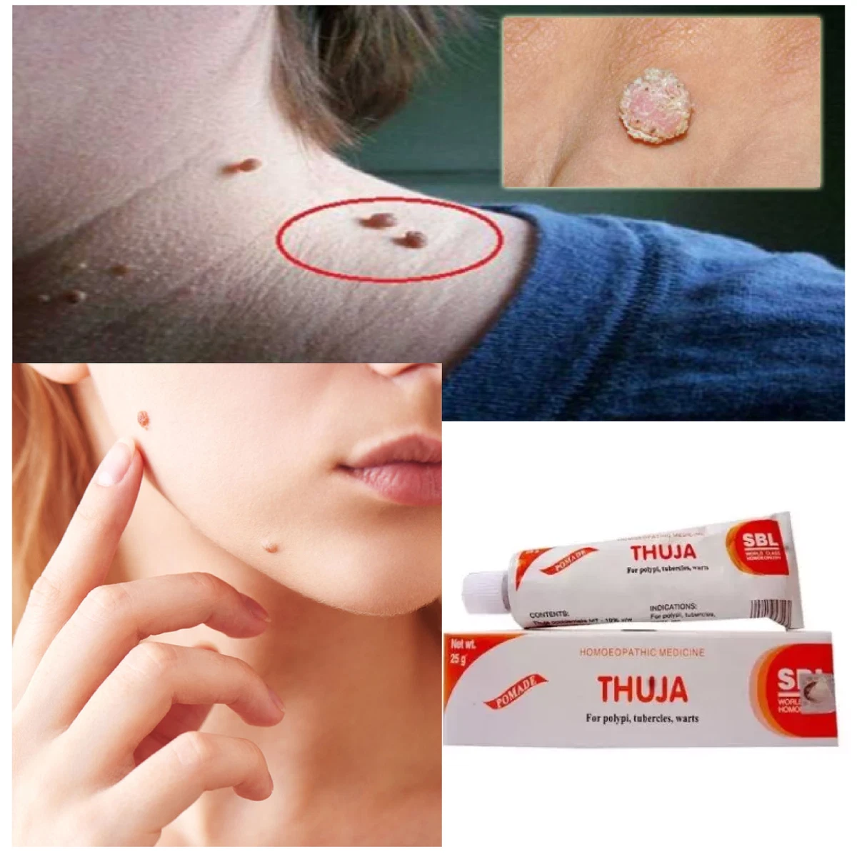Tubercle Skin