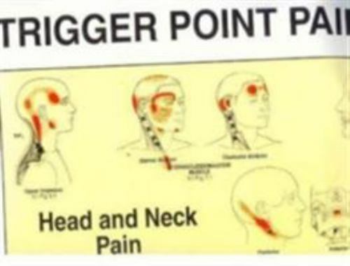 Trigger Point Pain Patterns by David G. Simons and Janet G. Travell ...