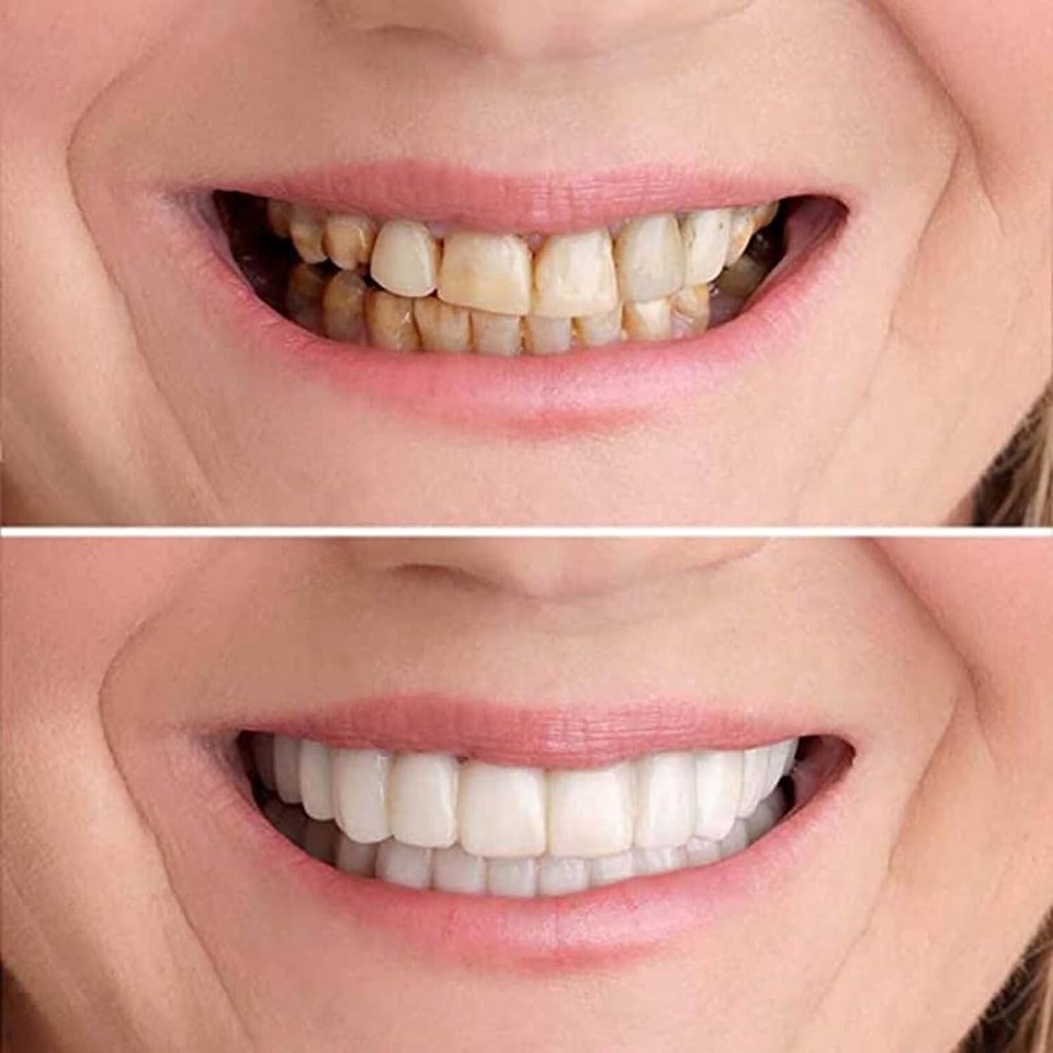 Smile Snap on False Teeth Set for Eat & Drink Denture Veneers Dental ...